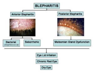Dry Eye and Blepharitis - Kahana Oculoplastic & Orbital Surgery